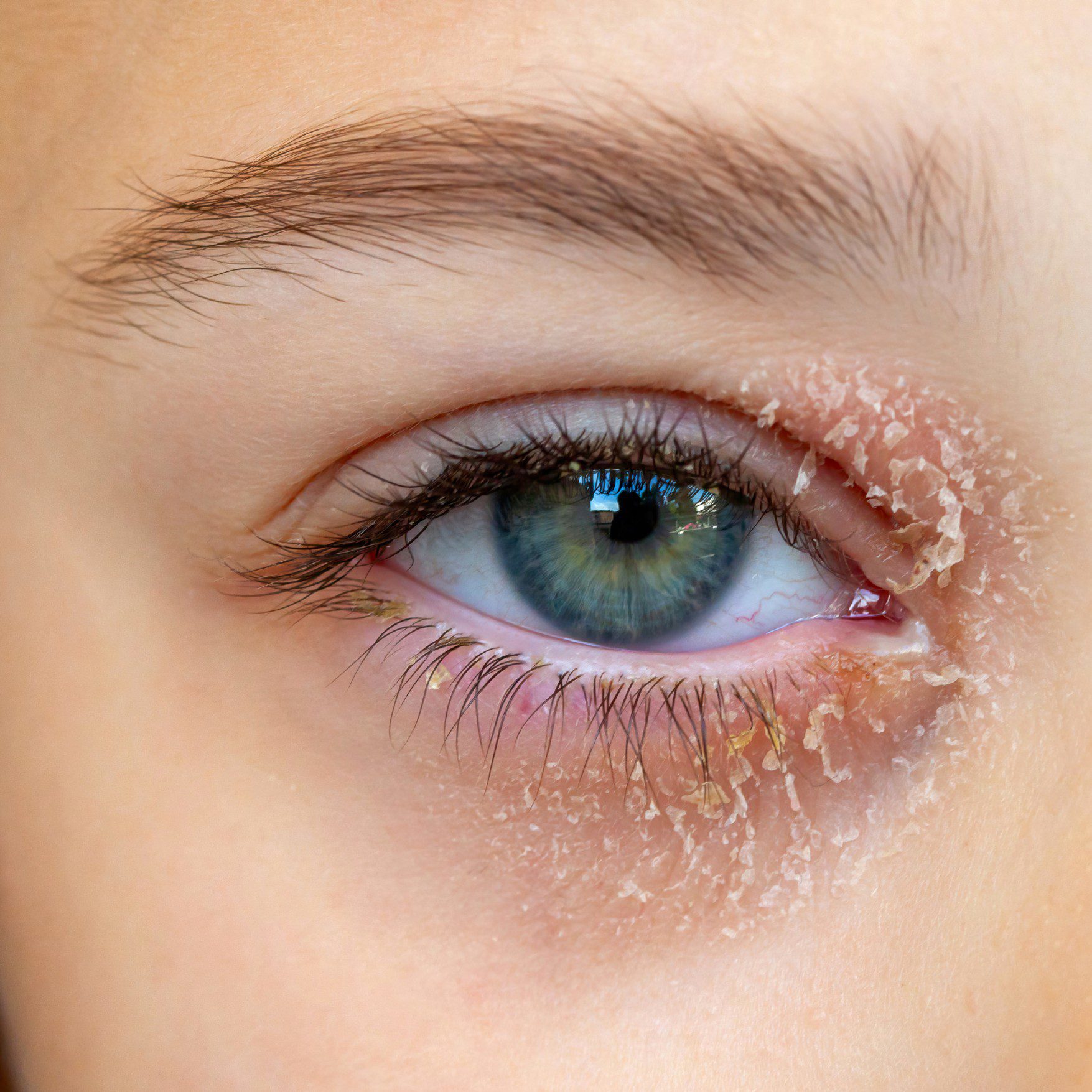 BLEFARITA - CAUZE, TIPURI SI TRATAMENT - Clinica de Oftamologie in ...