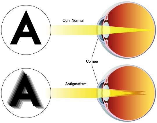 Astigmatism: Cauze, Simptome si Operatie - Ama Optimex