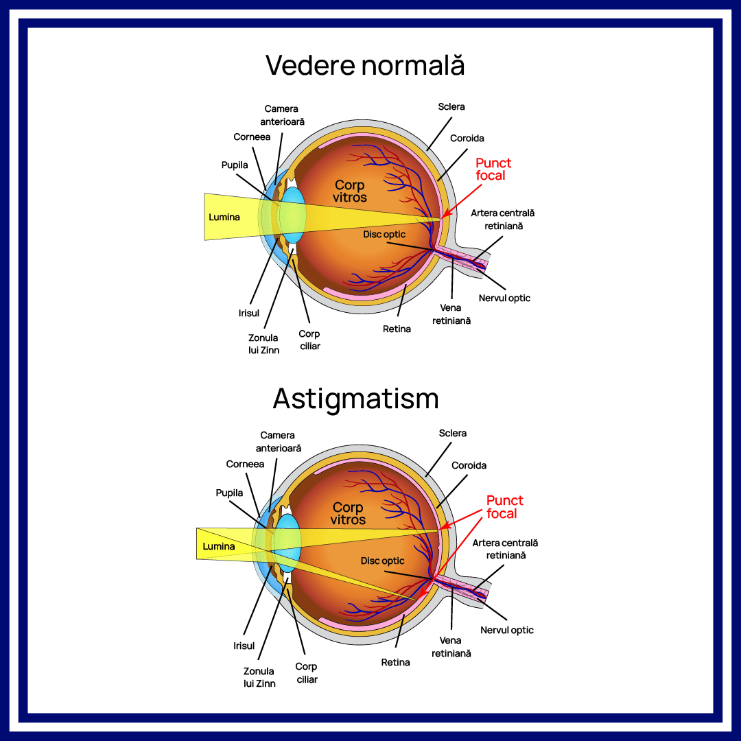 Astigmatism: Cauze, Simptome si Operatie - Ama Optimex