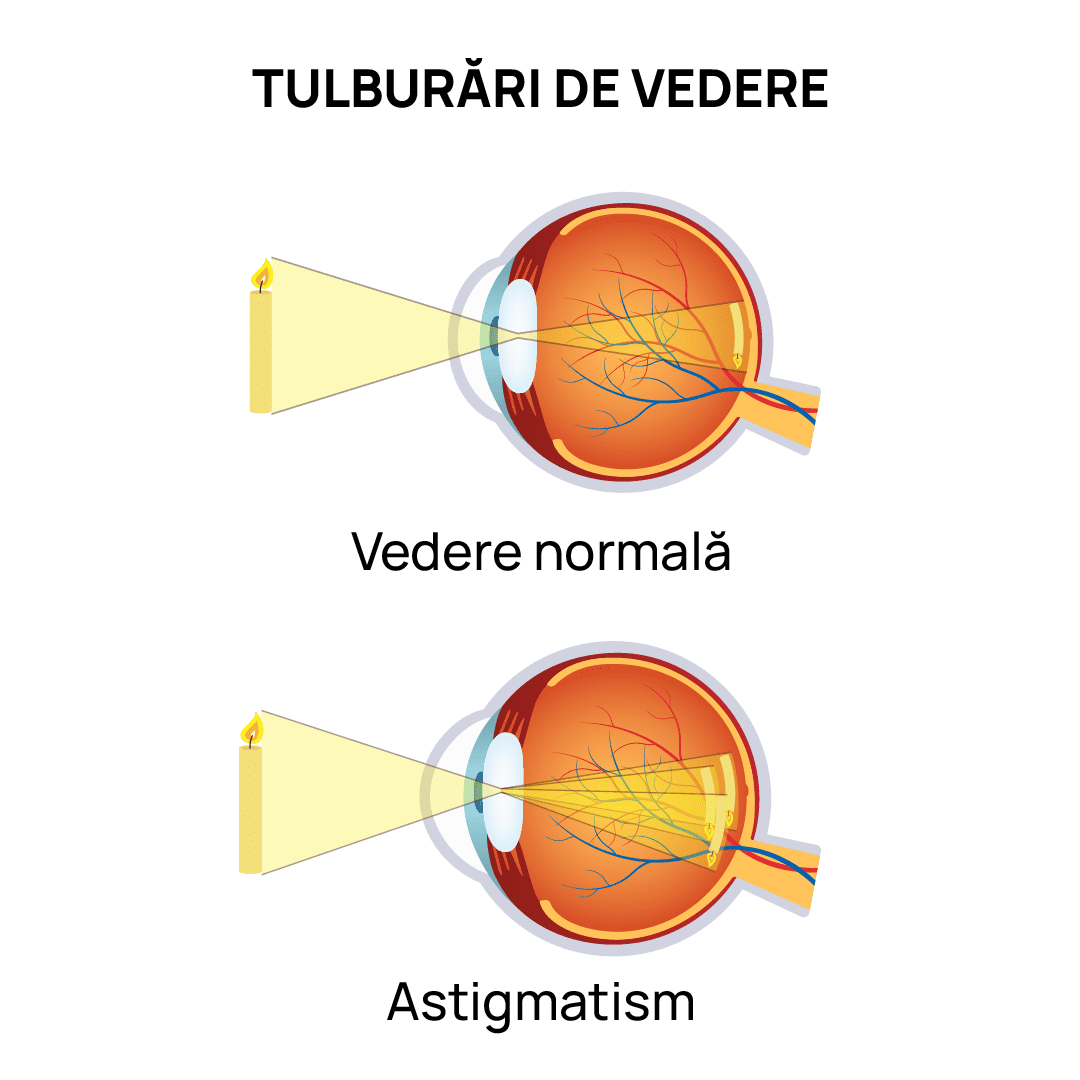 Astigmatism: Cauze, Simptome si Operatie - Ama Optimex